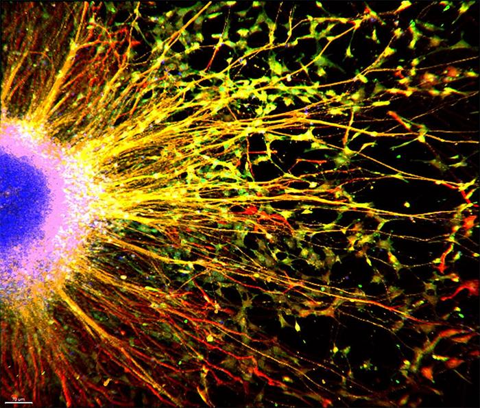 Cancer drug could ease cognitive function for some with autism ...